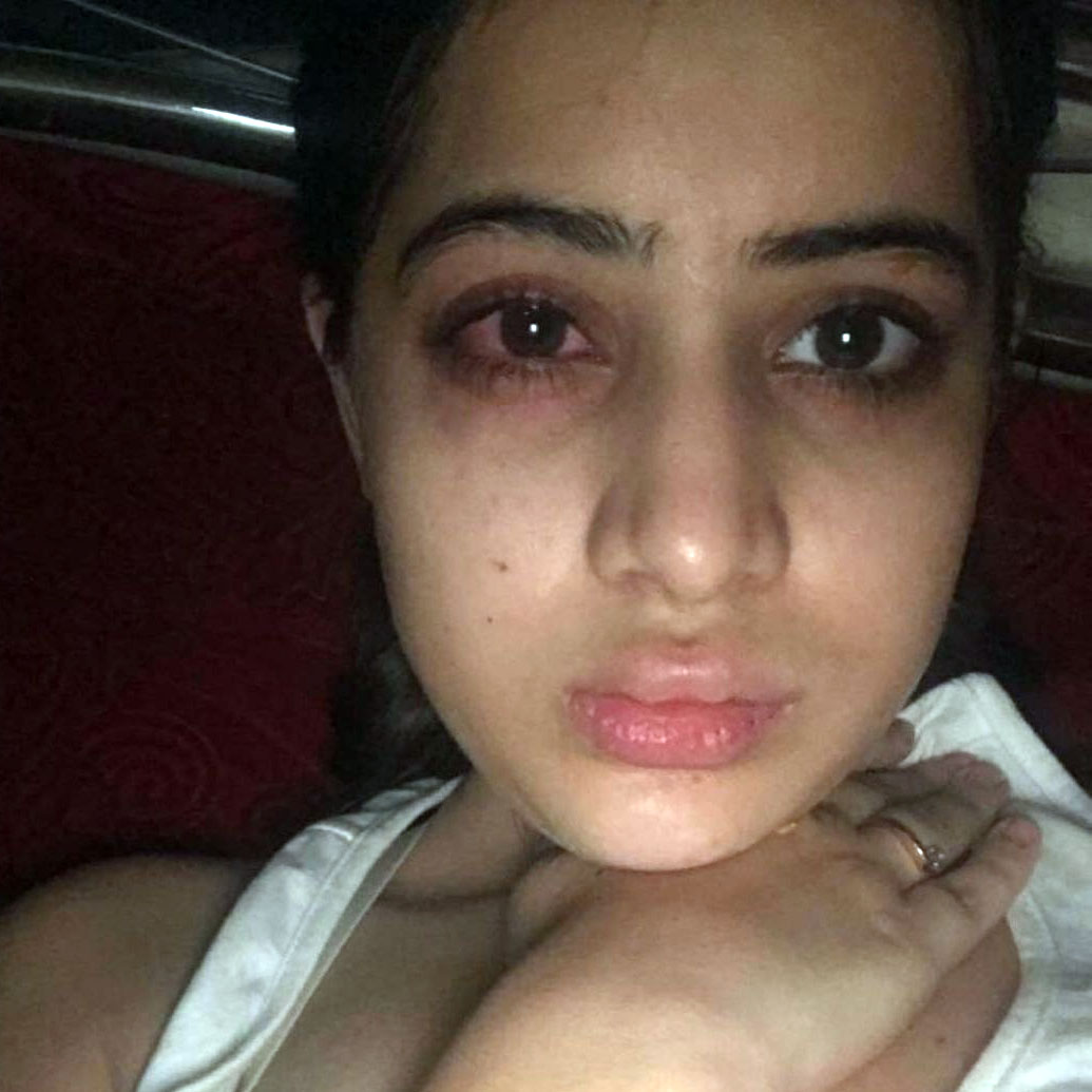 Urfi Javed Lip Filler: Advocacy for Responsible Enhancements